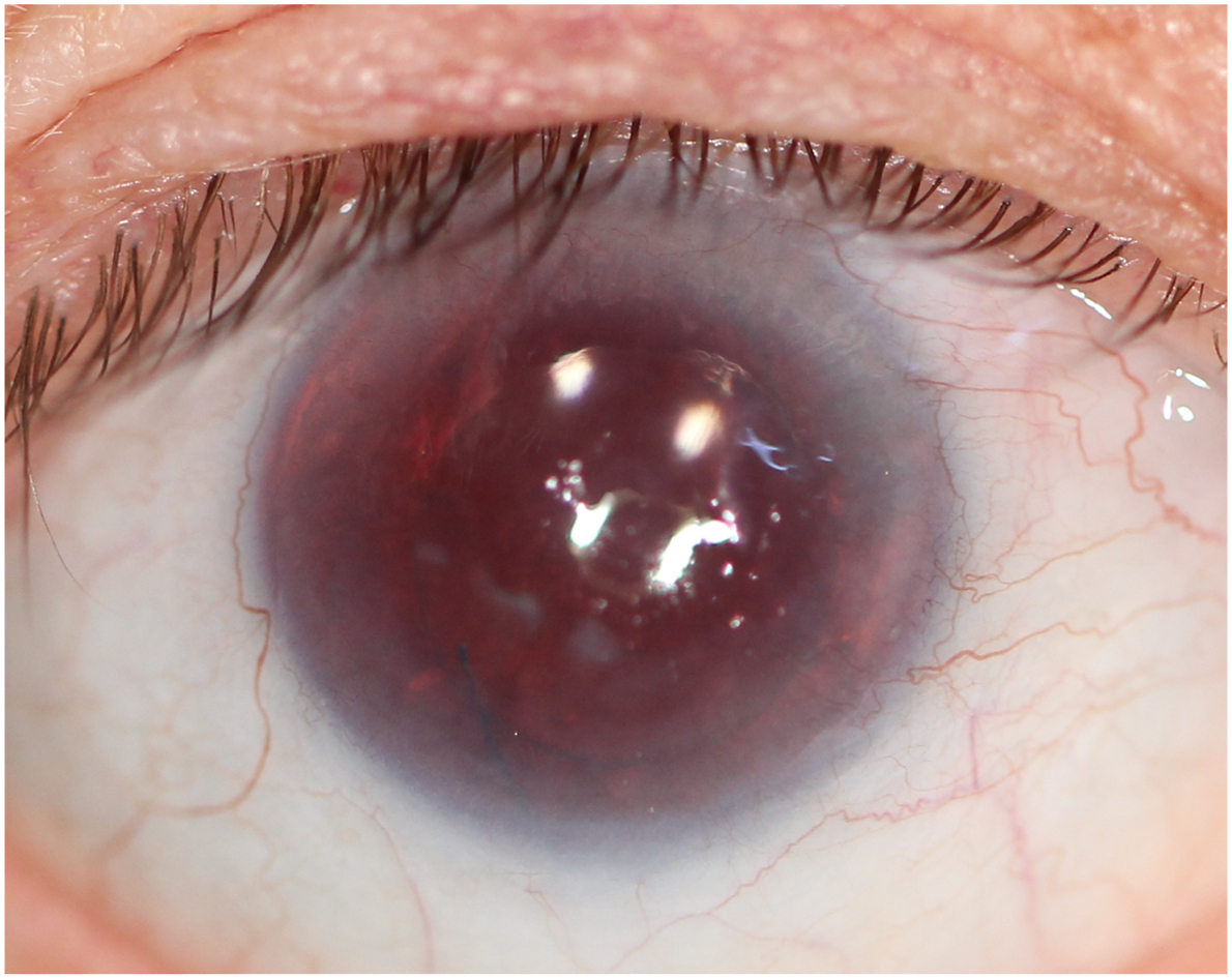 Use of the XEN gel implant in a patient with aniridia-associated ...