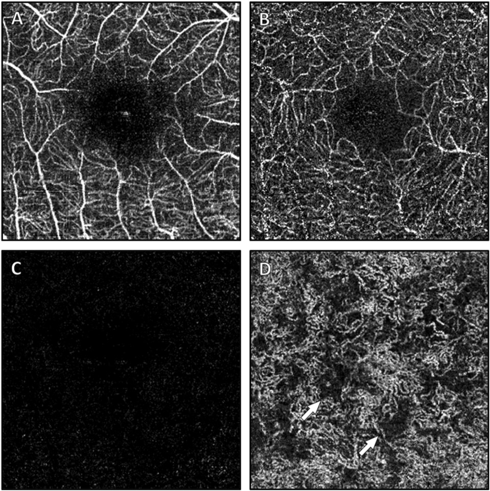 Fundus albipunctatus photoreceptor microstructure revealed using ...