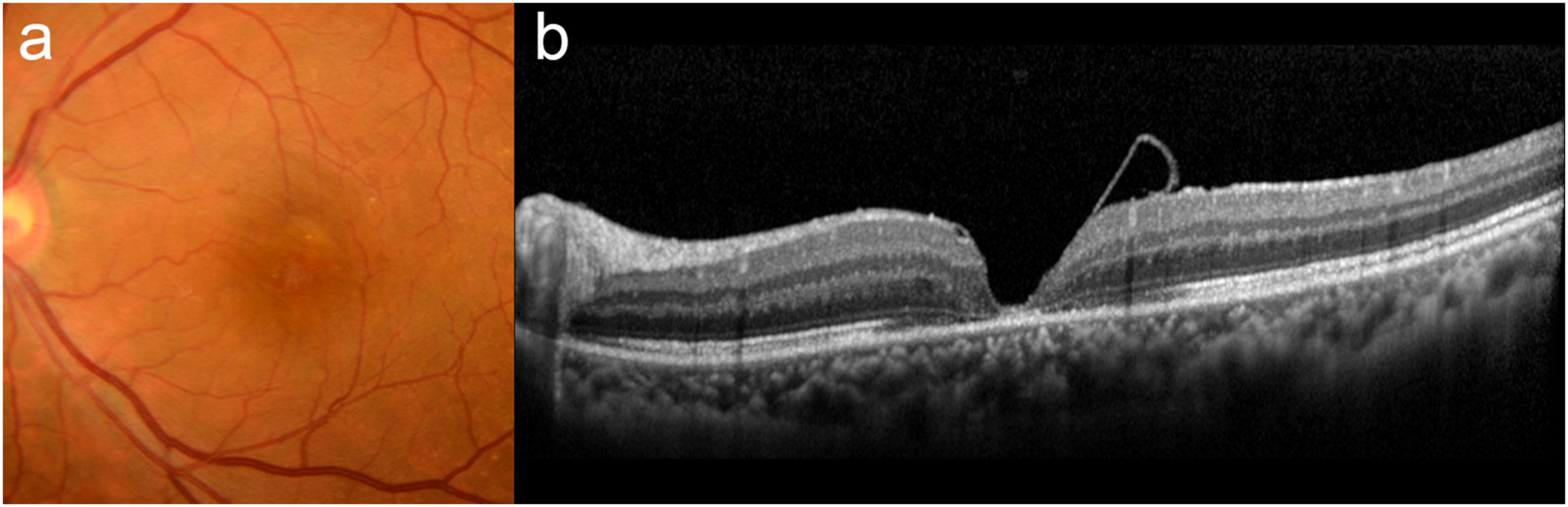 Partial detachment of internal limiting membrane flap and spontaneous ...