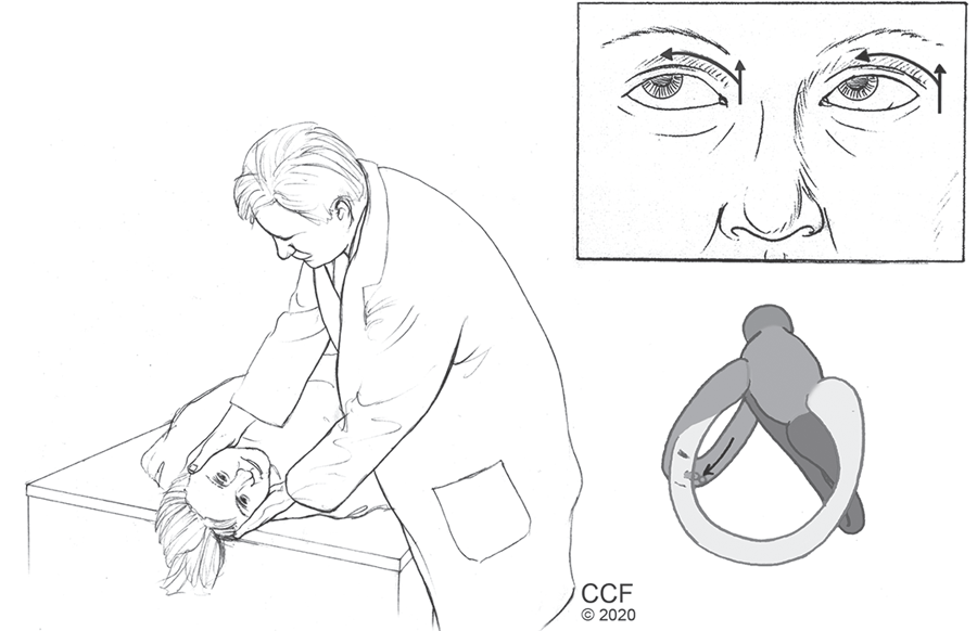 Hallpike Maneuver Illustration