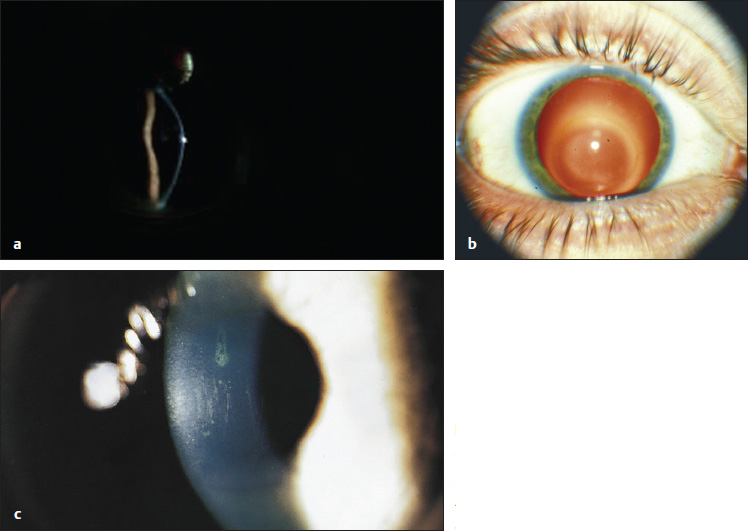 The Cornea | Ento Key