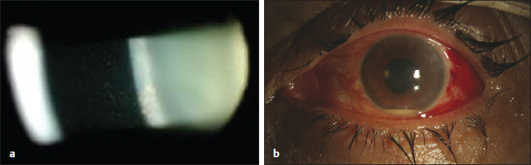 The Uveal Tract | Ento Key