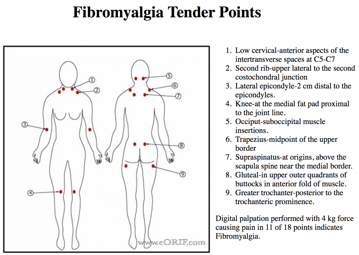 Diagram Of Fibromyalgia Tender Points Fibromyalgia Points Pa