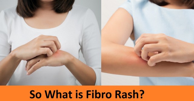 How to Deal With Fibromyalgia Rash and Skin Problems - Women With ...