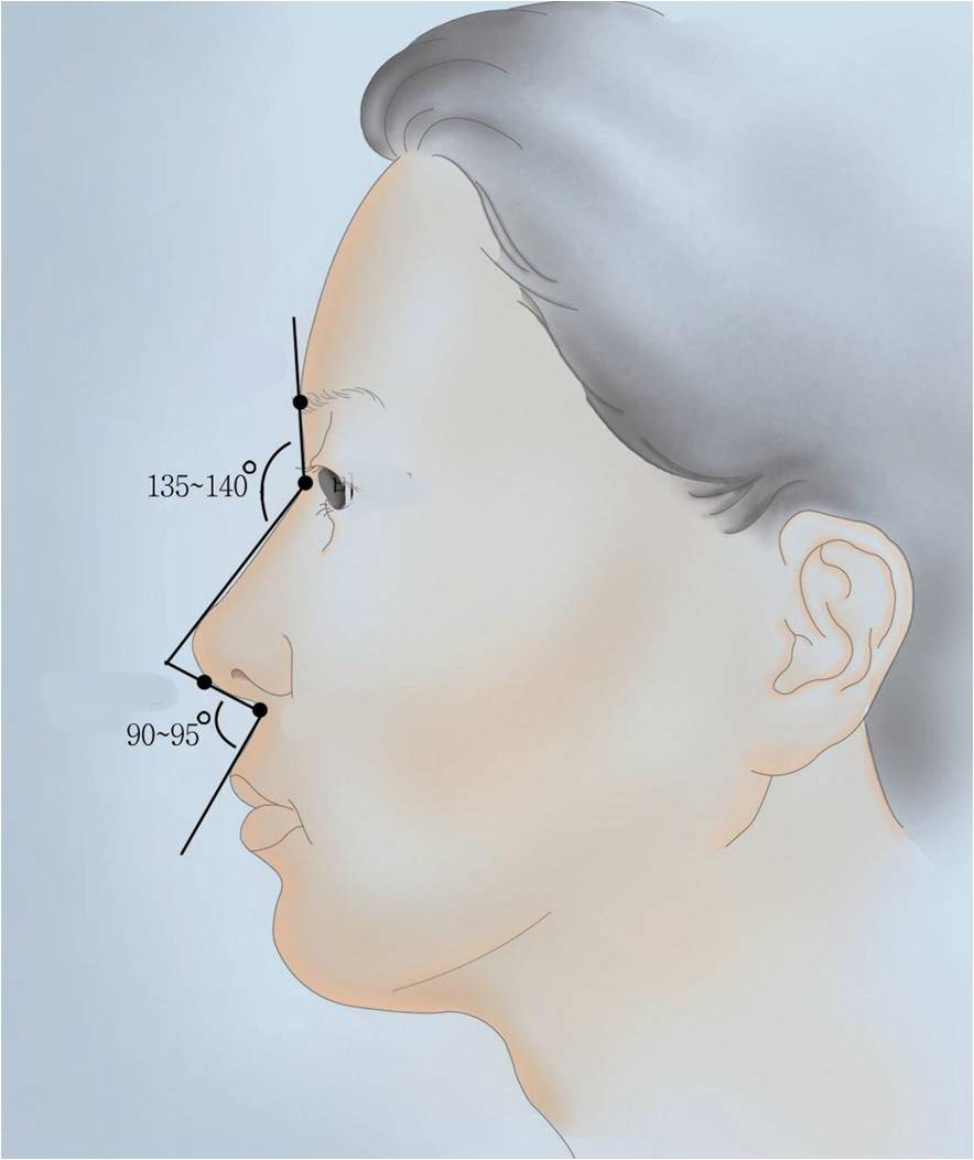 Upturned nose correction with rhinoplasty by Hanabiclinic