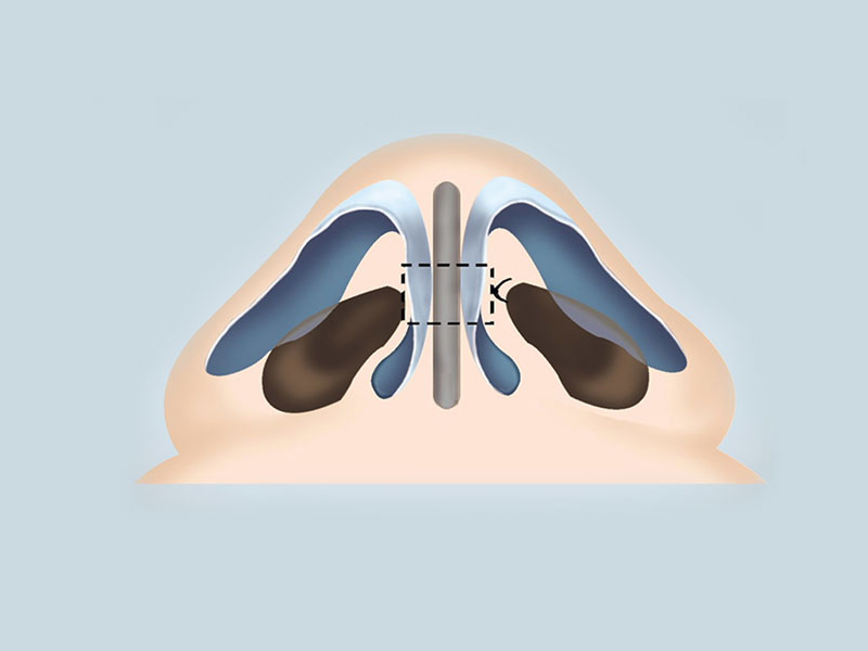 Nasal tip plasty using nasal septum cartilage - HANABI RHINOPLASTY CLINIC