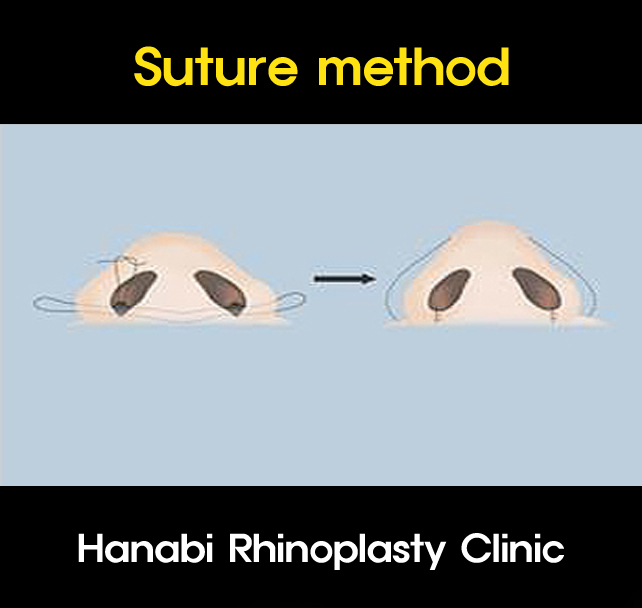Alar base reduction surgery - HANABI RHINOPLASTY CLINIC