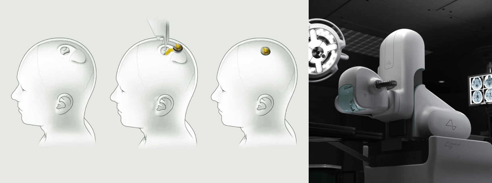 Neuralink-Installation_Hookedontech | Hooked On Tech