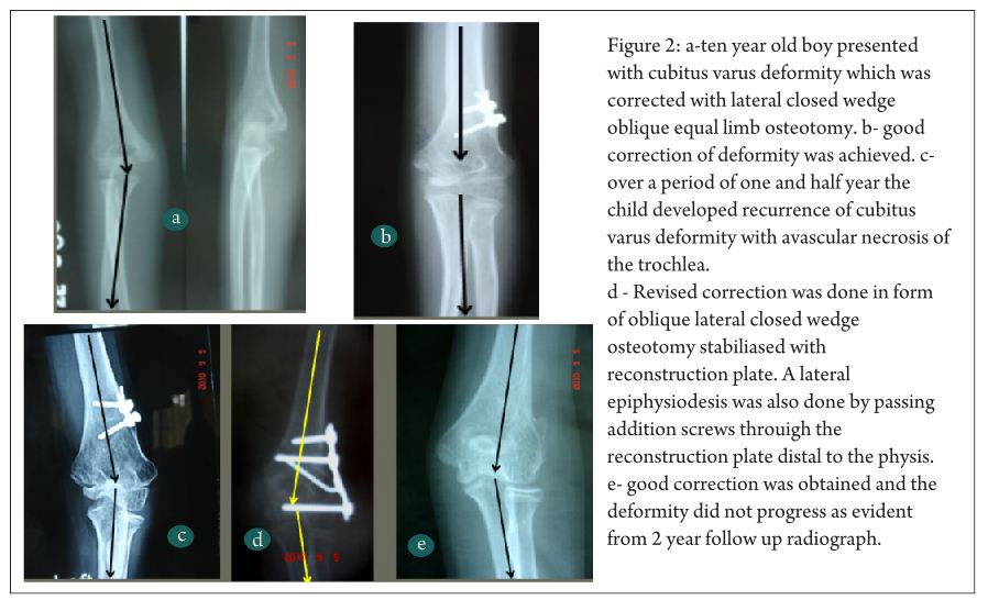Cubitus varus Archives - International Journal of Paediatric Orthopaedics