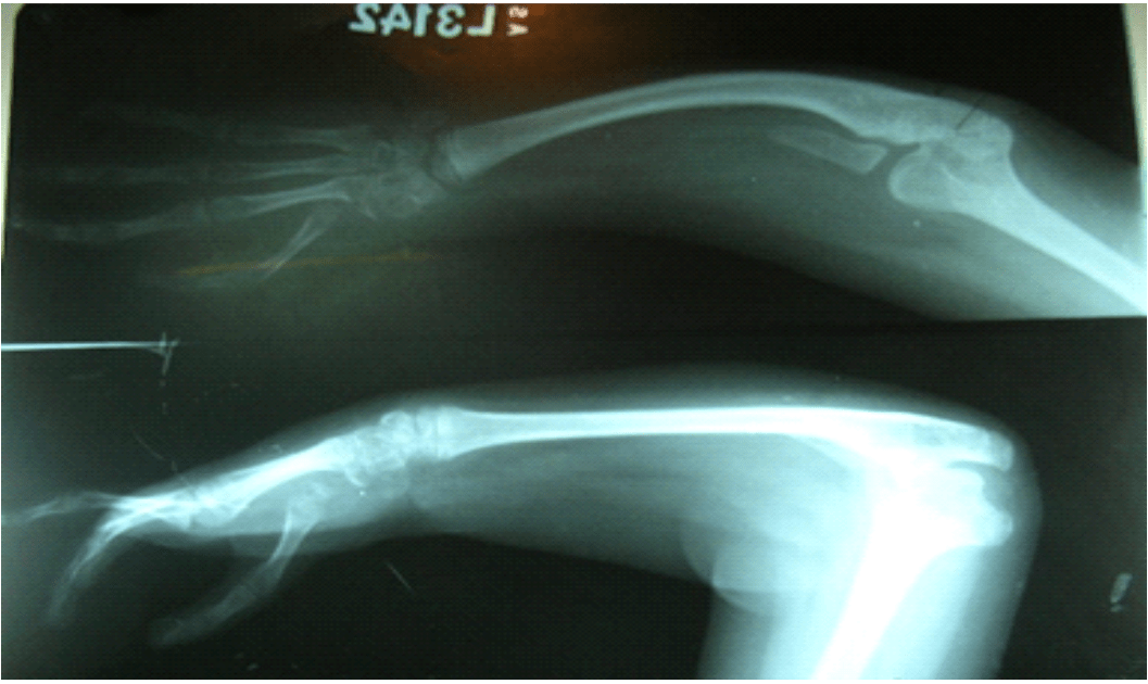 Radial Hemimelia Treatment - Decision Making and Management, Algorithm ...