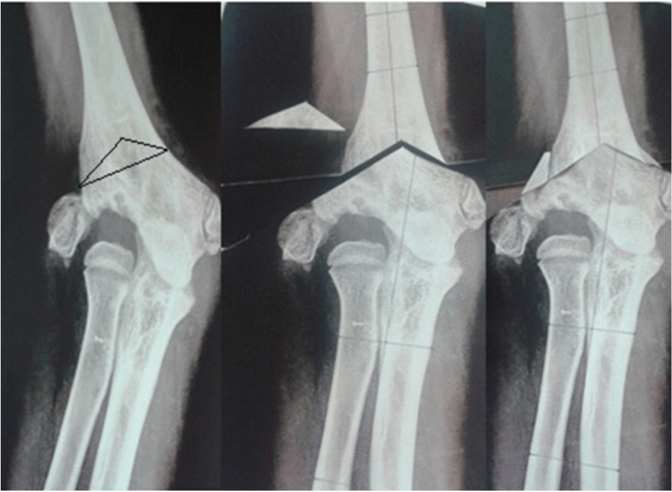 Clinical and Radiological Outcome following Kim's Step cut Translation ...