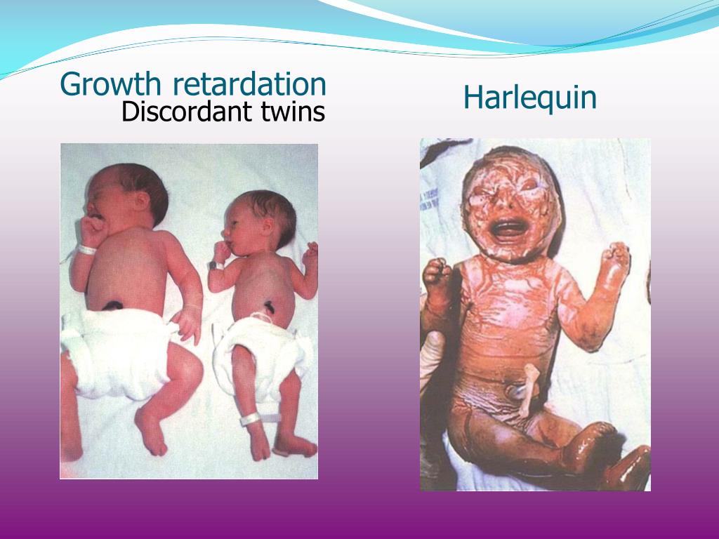 Signs Of Mental Retardation In Newborn Babies BABBIES CIP signs-of-mental-retardation-in-newborn-babies-babbies-cip