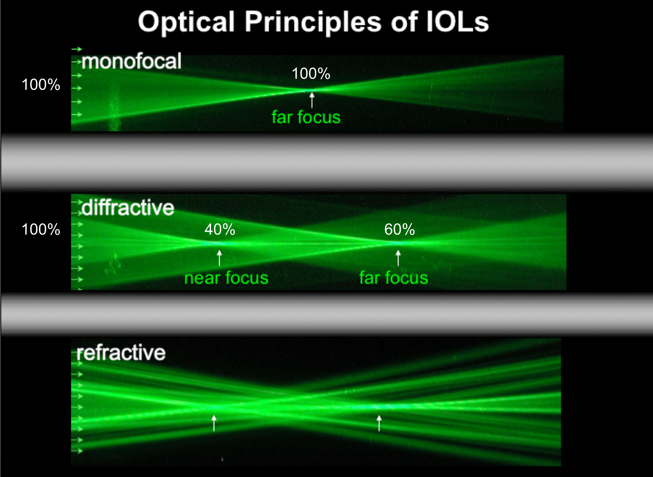 Lens Consultation | Dimitri Eye Surgery