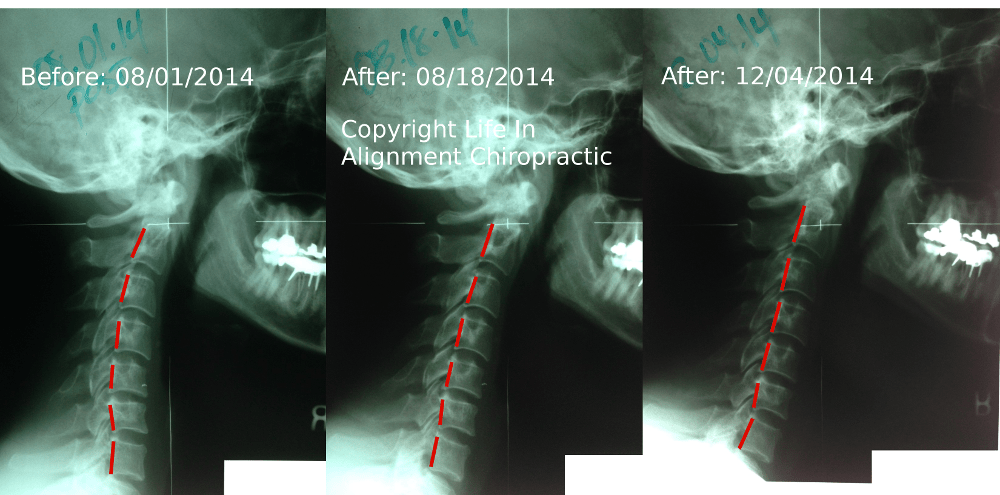 i-have-a-reverse-cervical-curve-is-this-a-problem-can-you-fix-it
