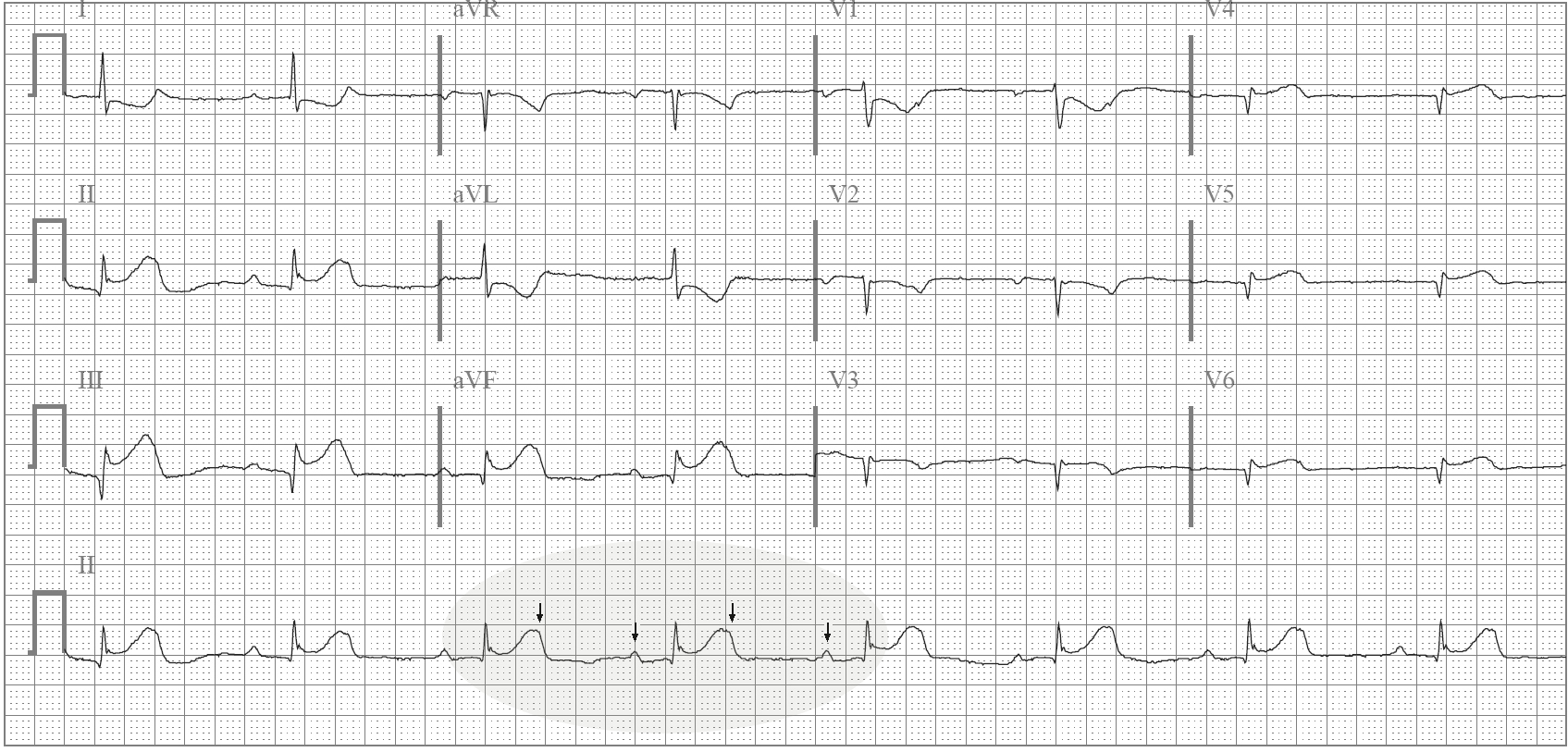 EKG COMPETITION 11/09 | THE LINCOLN HOSPITAL MEDICINE BLOG