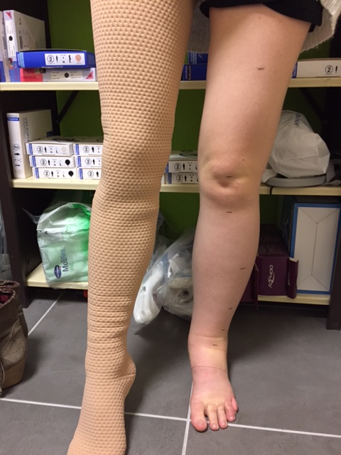 New night garment- Jobst Relax. – The Lymphosaurus Rex