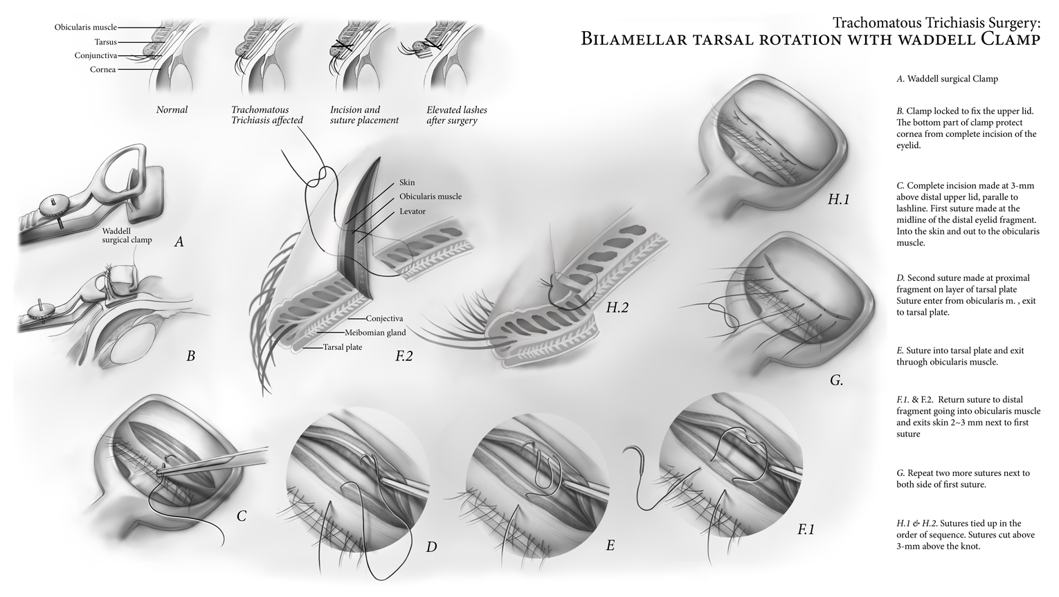 Trachomatous Trichiasis Surgery - Madeline M Lee