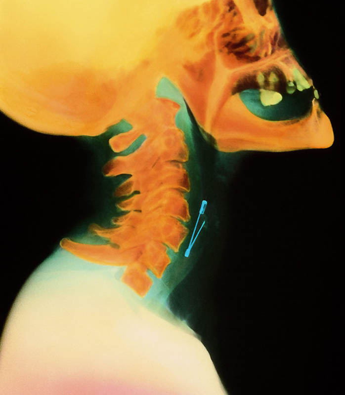 Most bizarre X-rays in the history of medicine (20 pictures) | Memolition