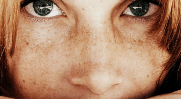 SciShow video explains why some people have freckles and others don't ...