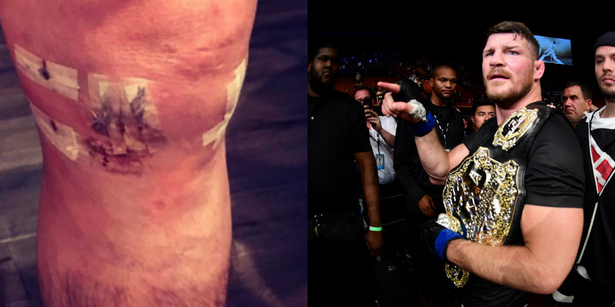 UFC news: Michael Bisping shows off severely swollen knee after surgery ...
