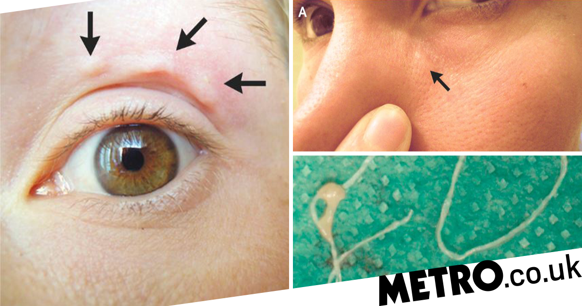Bumps on woman's face turned out to be a parasitic worm living under ...
