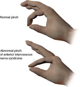 Fractures and Dislocations of the Wrist | Musculoskeletal Key