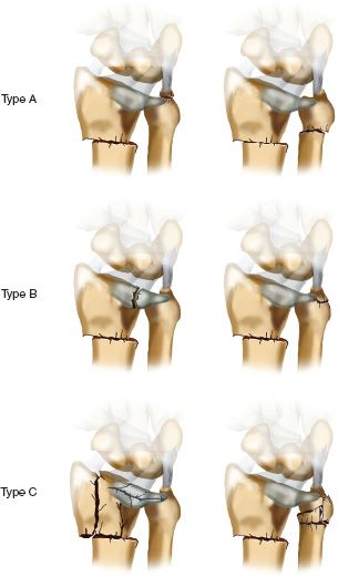 Fractures and Dislocations of the Wrist | Musculoskeletal Key