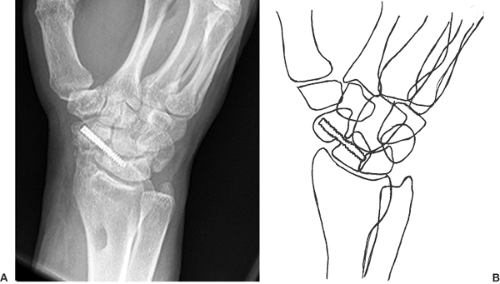 Volar Wedge Graft for Scaphoid Non-Union with Humpback Deformity ...