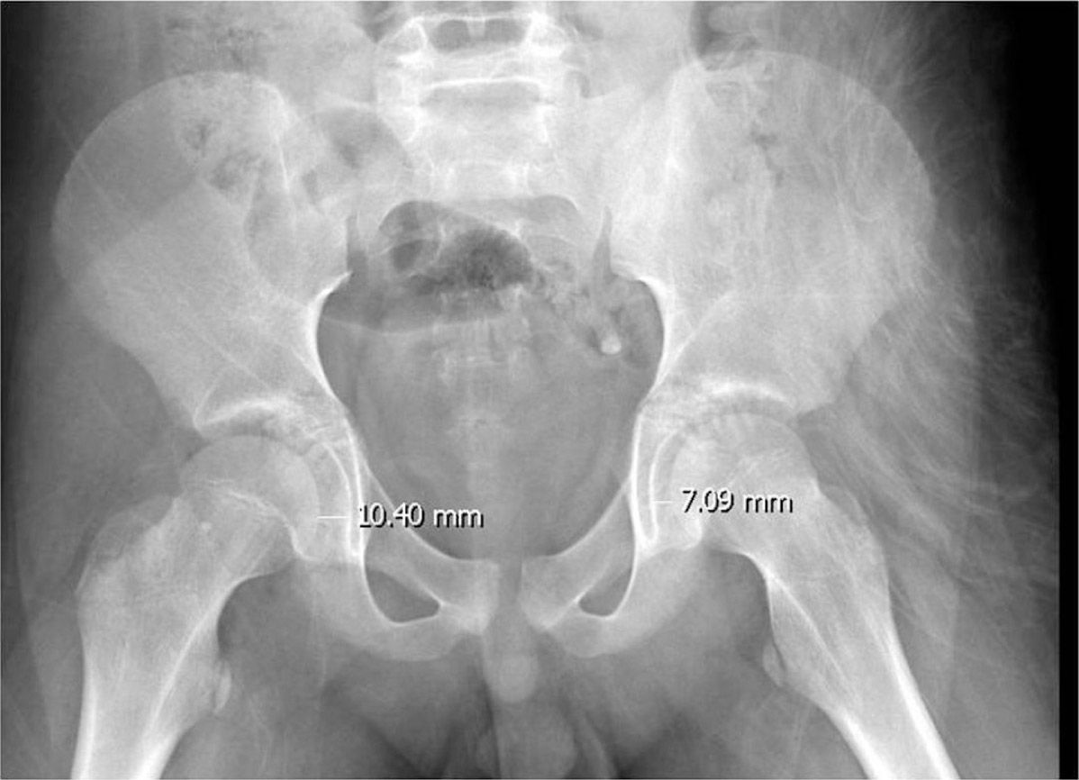 Hip Dislocations, Femoral Head Fractures, and Acetabular Fractures ...