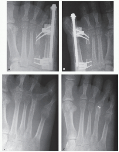 Brachymetatarsia | Musculoskeletal Key