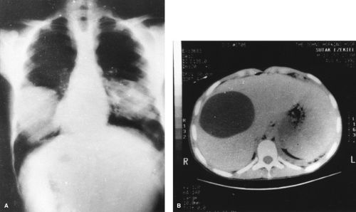 The Cestodes | Musculoskeletal Key