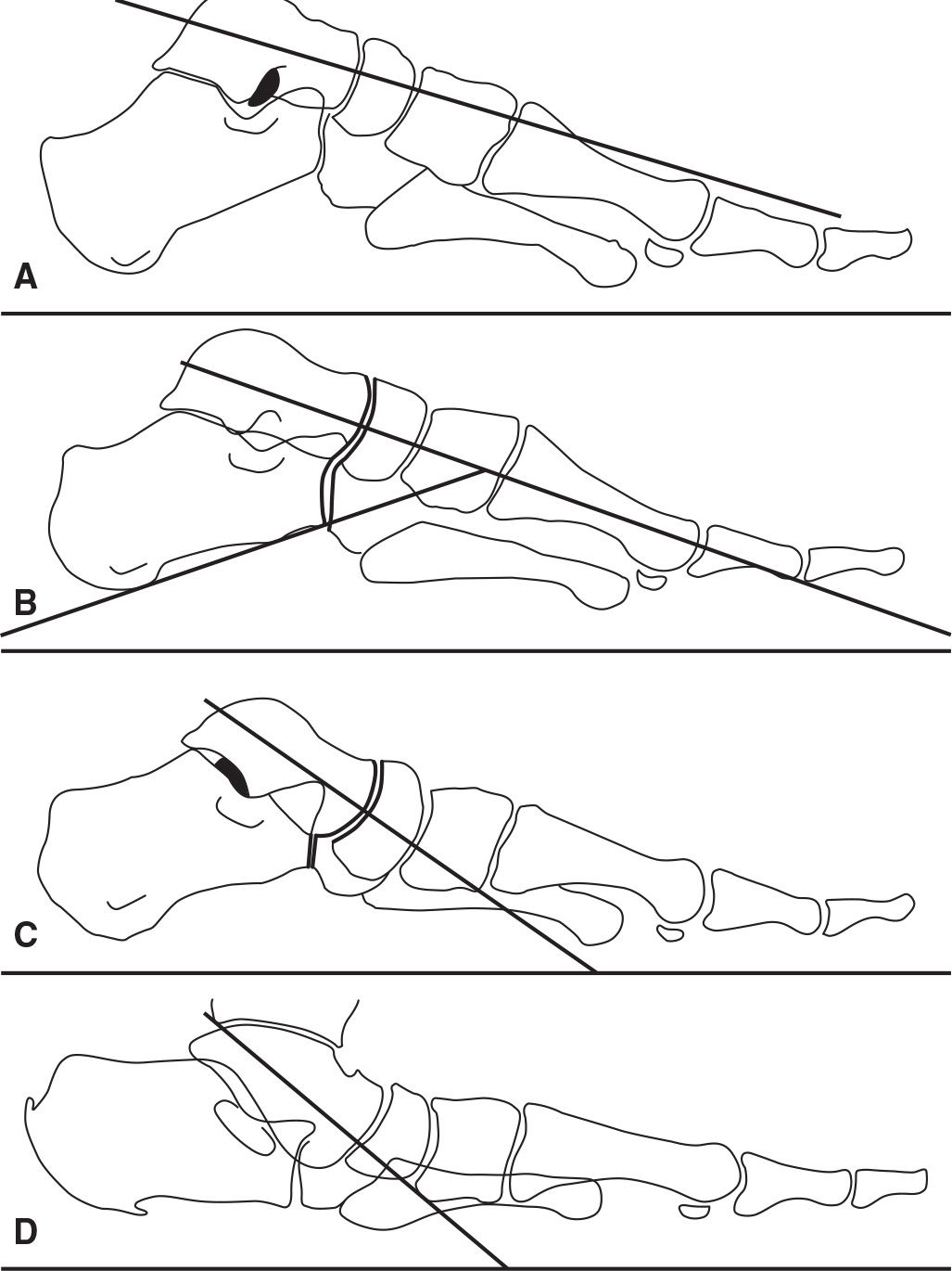 12: Principles of Biomechanical Radiographic Analysis of the Foot ...