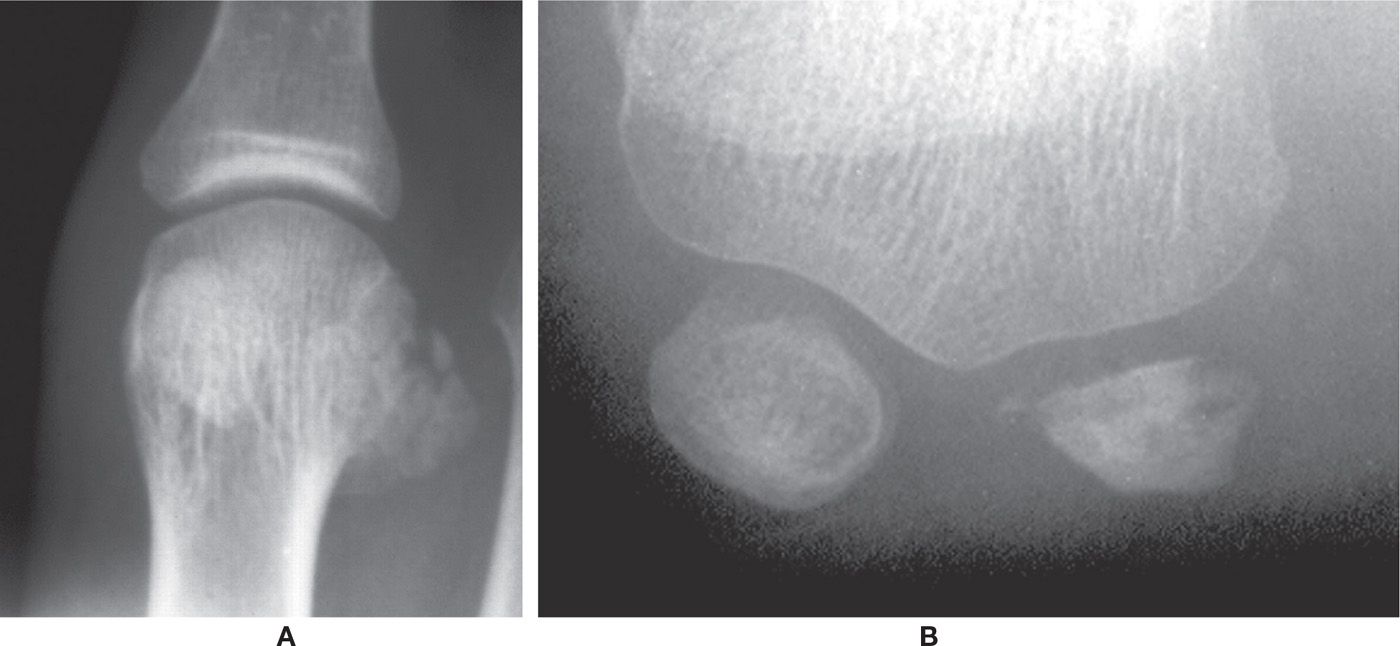 17: Osteonecrosis and Osteochondrosis | Musculoskeletal Key