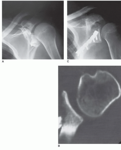 Open Reduction and Internal Fixation of Glenoid Fractures ...