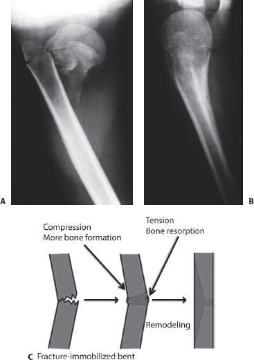 The Immature Skeleton | Musculoskeletal Key