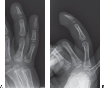 Cast and Splint Immobilization, Remodeling and Special Issues of ...