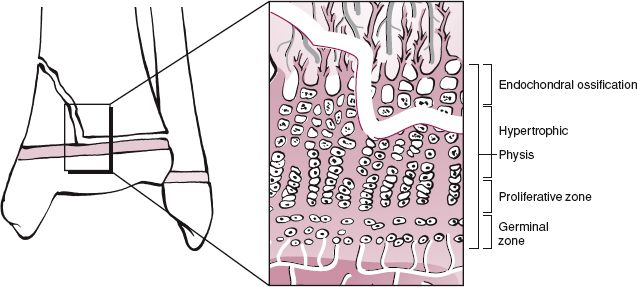 Physeal Injuries and Growth Disturbances | Musculoskeletal Key
