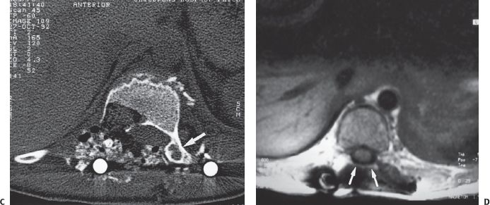 Pathologic Fractures | Musculoskeletal Key