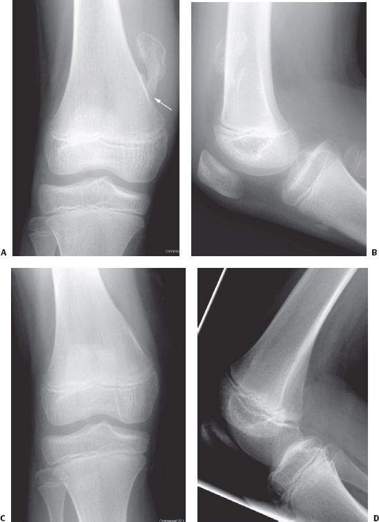 Pathologic Fractures | Musculoskeletal Key