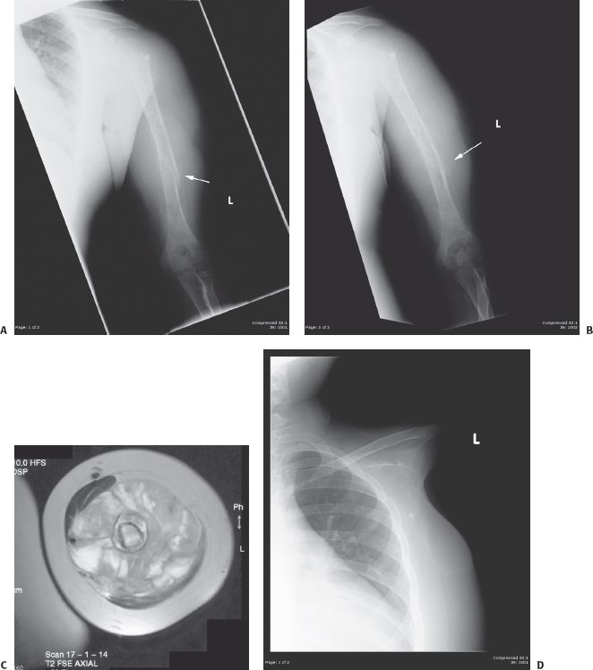 Pathologic Fractures | Musculoskeletal Key