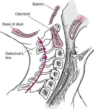 Cervical Spine Injuries in Children | Musculoskeletal Key