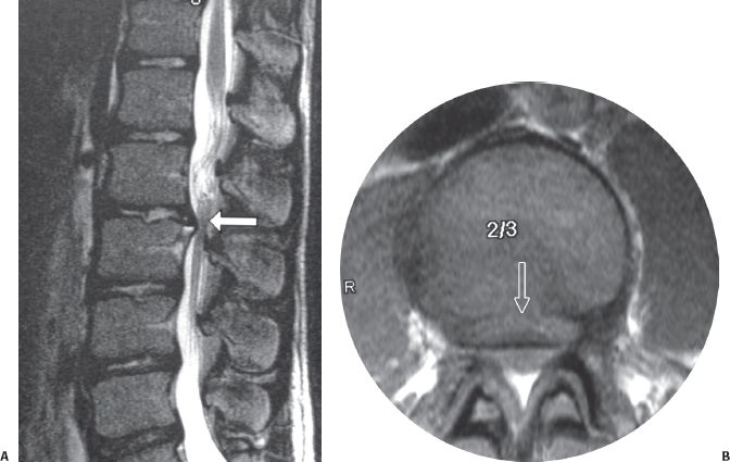 Thoracolumbar Spine Fractures | Musculoskeletal Key