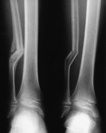 Fractures of the Shaft of the Tibia and Fibula | Musculoskeletal Key