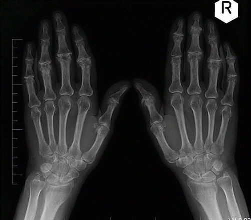 Osteoarthritis | Musculoskeletal Key