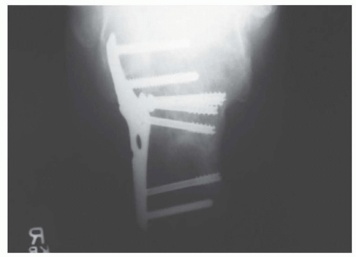 Minimally Invasive Operative Treatment of Displaced Intra-Articular ...