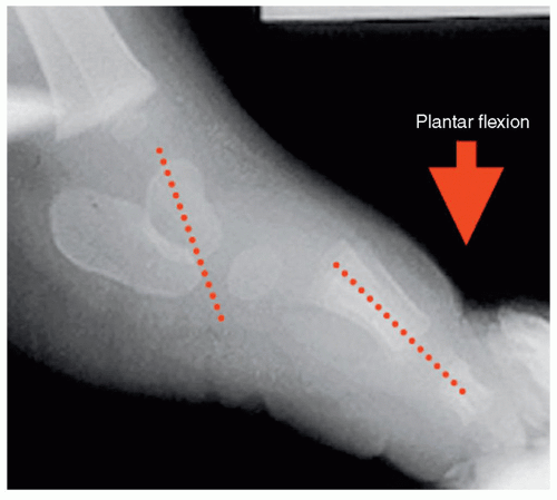 Foot and Ankle Deformity | Musculoskeletal Key