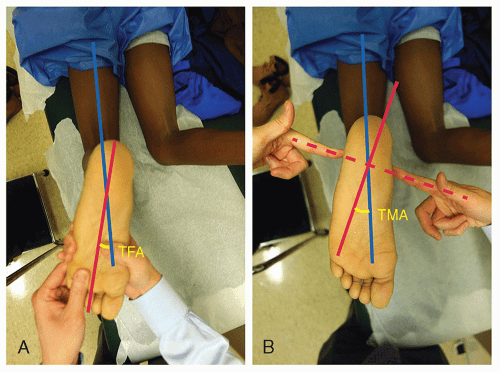 Limb Alignment and Limb Length Discrepancies | Musculoskeletal Key