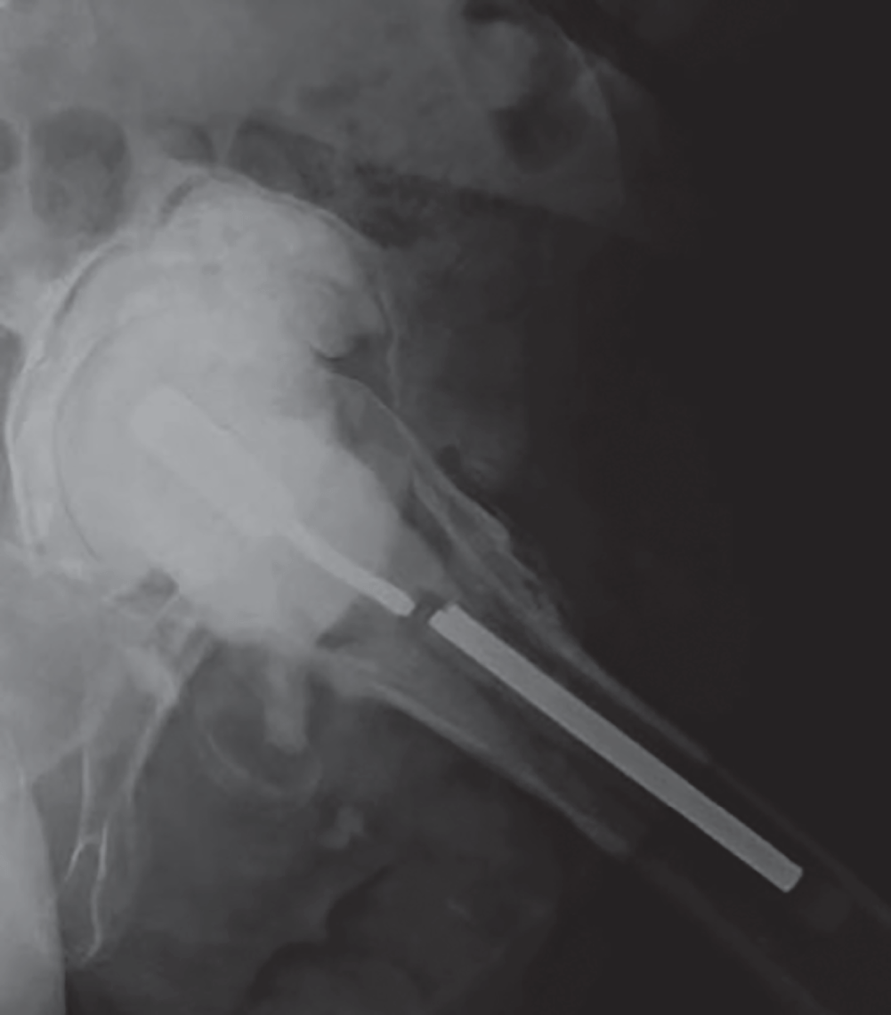 Revision of the Acetabular Component | Musculoskeletal Key