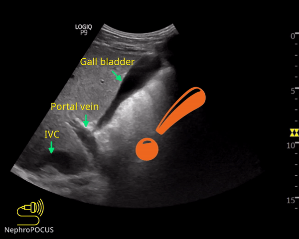 The POCUS Kingdom – NephroPOCUS