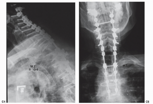 Surgical Management of Neuromuscular Kyphosis | Neupsy Key